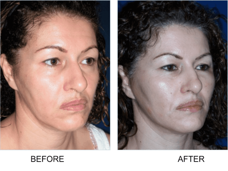 Case 33: One Hour SMART Facelift - Maryland Plastic Surgery