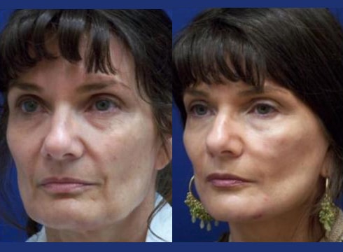 One Hour SMART Facelift in Glen Burnie, MD | Maryland Plastic Surgery