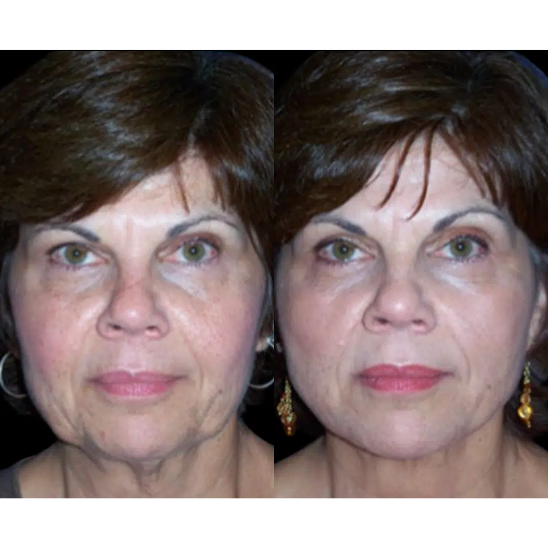 Facelift in Millersville, MD | Maryland Plastic Surgery