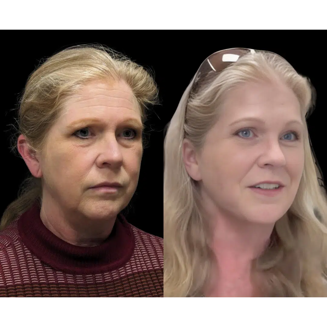 Pixel Plasma - Maryland Plastic Surgery