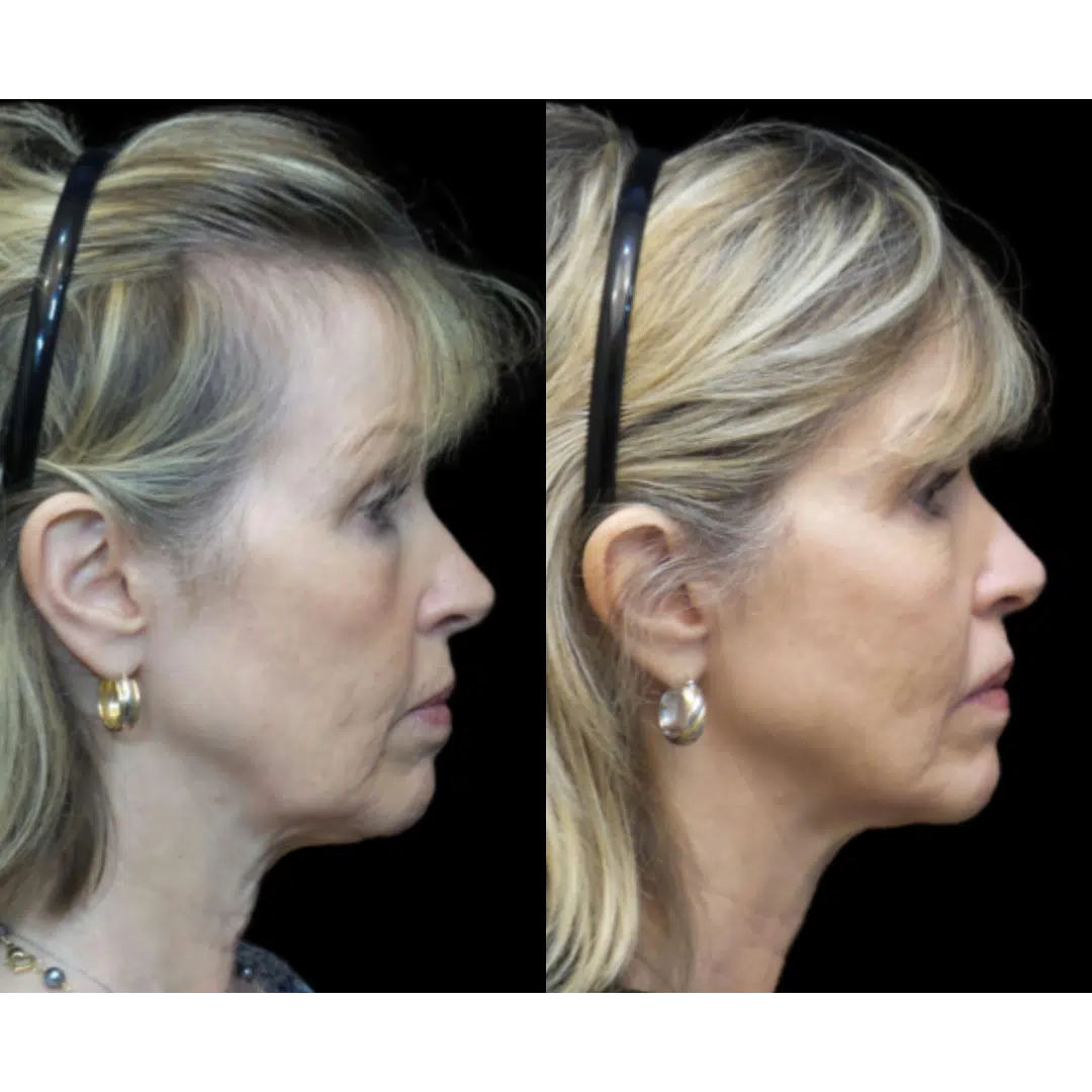 Facelift in Millersville, MD | Maryland Plastic Surgery