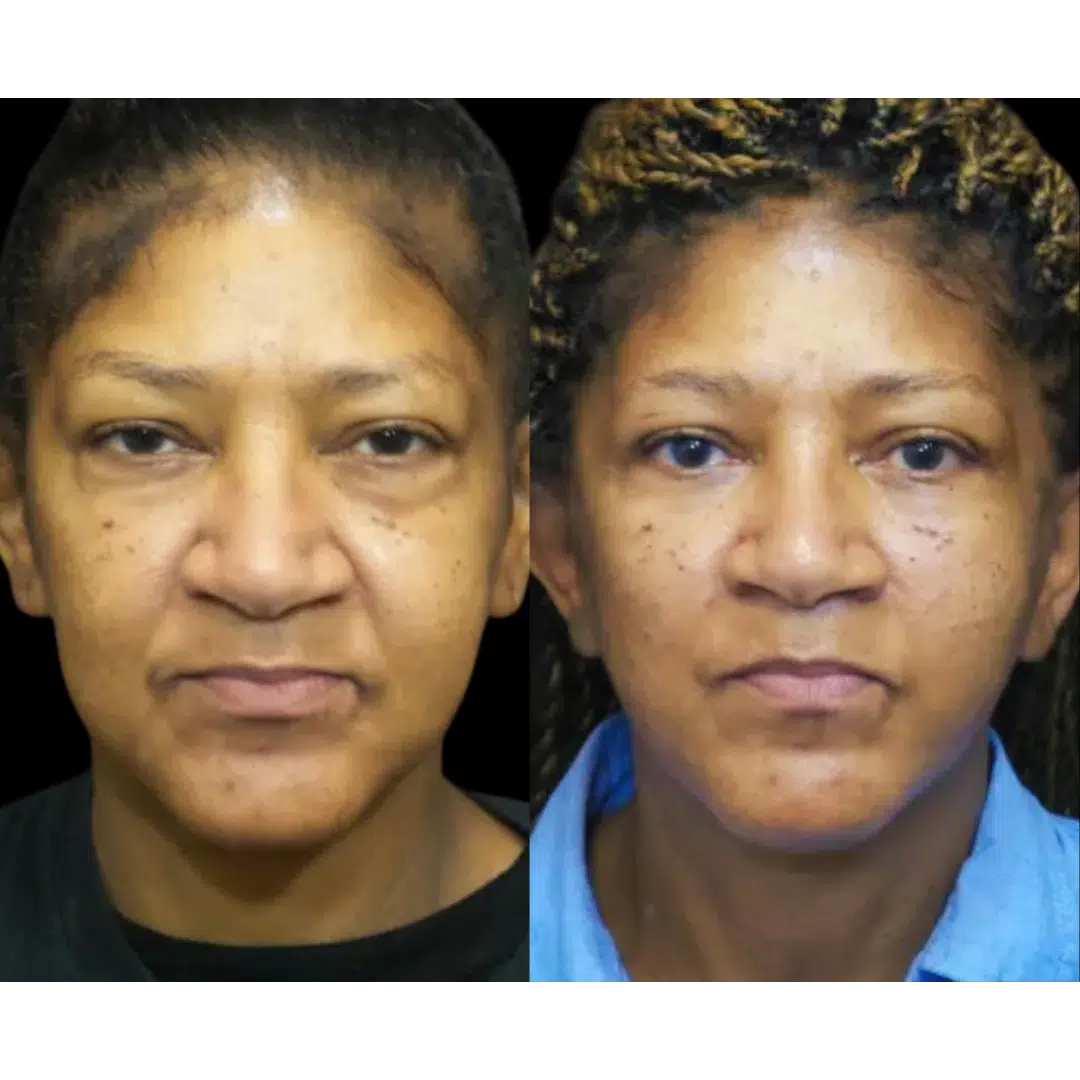 Facelift in Millersville, MD | Maryland Plastic Surgery